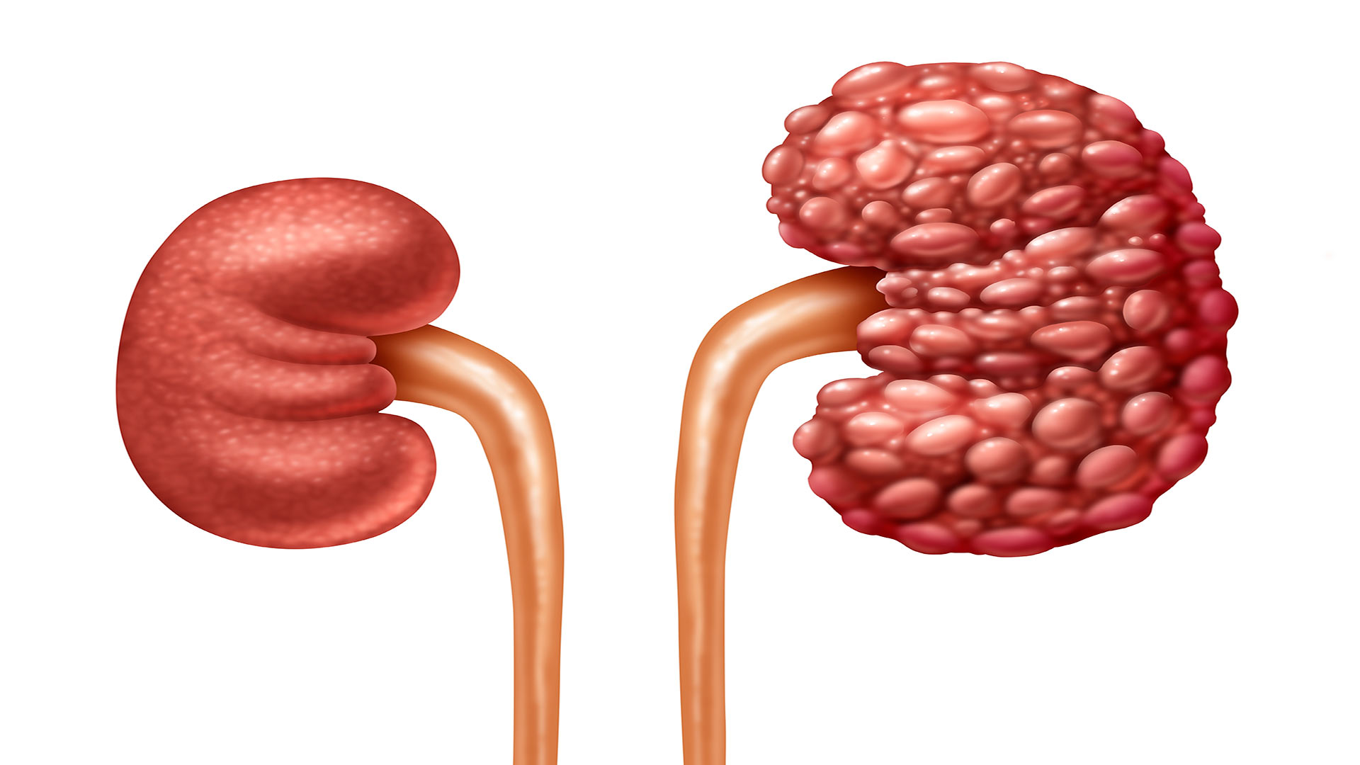 O que são nefropatias? - Nefromed | Nefrologia